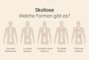 Formen von Skoliose » Ihr Orthopäde in Frankfurt